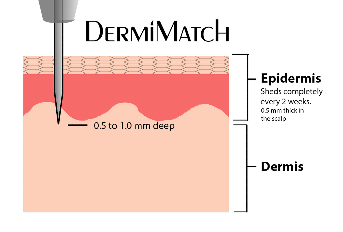 How Deep Should My Needle Go DermMicro Scalp Products How Deep Should My Needle Go DermMicro Scalp Products