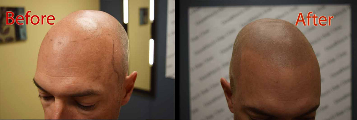 Maintaining and Sterilizing Scalp Micropigmentation Pens – DermMicro ...