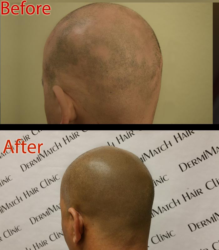 Managing Scalp Shine: Tips for a Matte Appearance – DermMicro Scalp ...