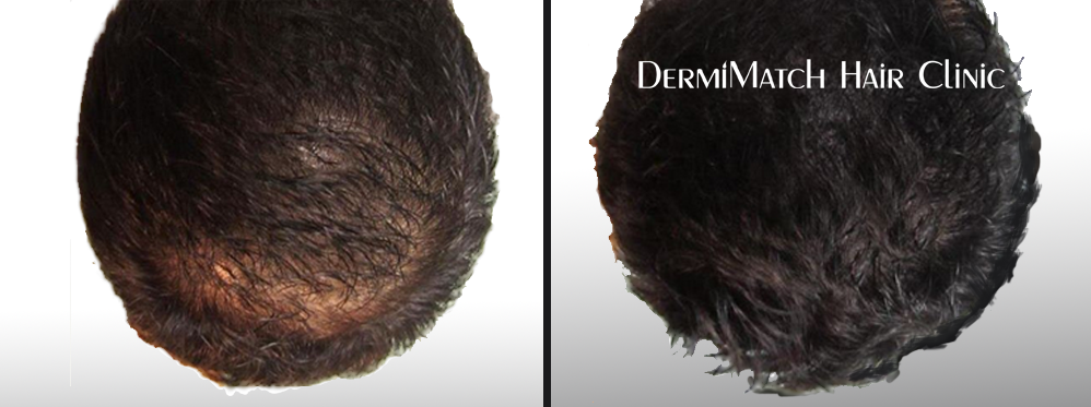 Is SMP for Long Hair A Good Option? – DermMicro Scalp Products