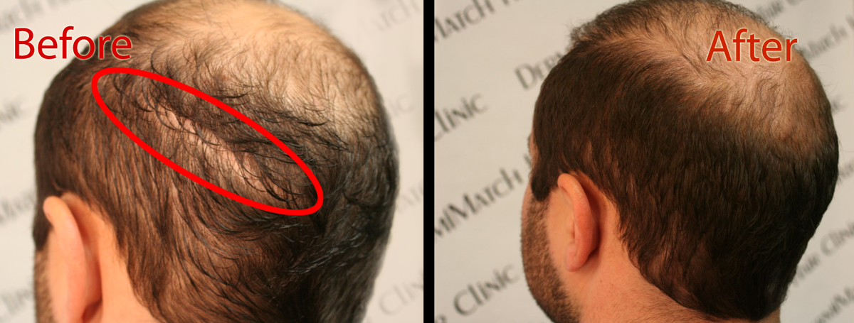 Scalp Rejuvenation: Correcting Bad SMP and Concealing Spots – DermMicro ...