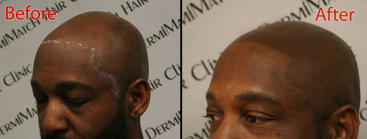 How To Choose SMP Needles – DermMicro Scalp Products