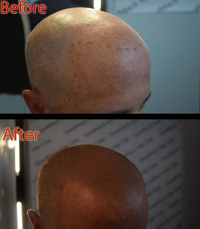 Can micropigmentation go wrong? – DermMicro Scalp Products