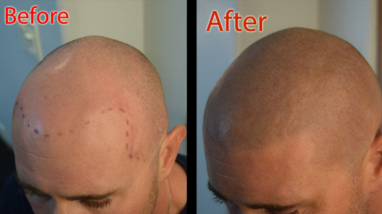 Why is a bald head so shiny? – DermMicro Scalp Products
