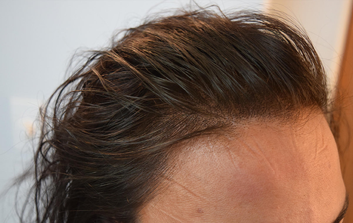 Does SMP Work With Long Hair? – DermMicro Scalp Products